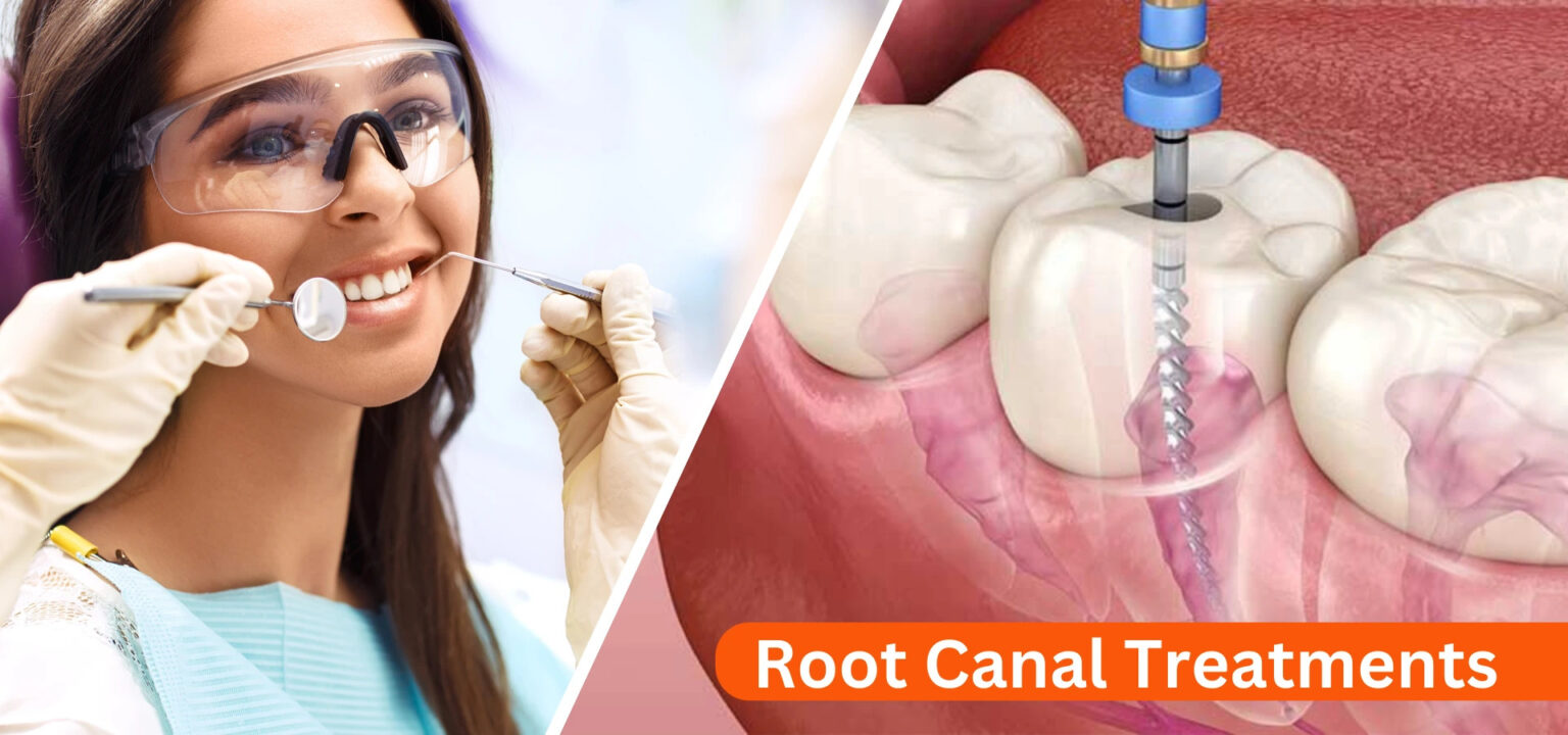 Top Benefits of Root Canal Treatment in Gurgaon for Healthy Teeth - Dr ...